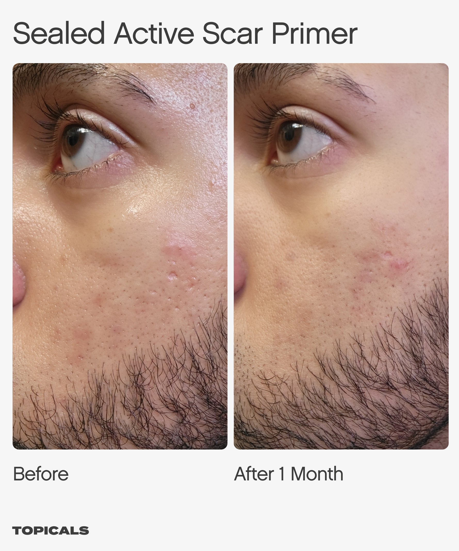 Scar Primer Dark Spots Serum Post Acne Kit Topicals